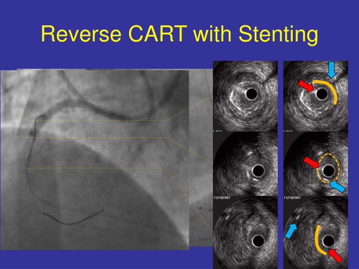 PPT - IVUS Guided CTO PCI PowerPoint Presentation - ID:3971980