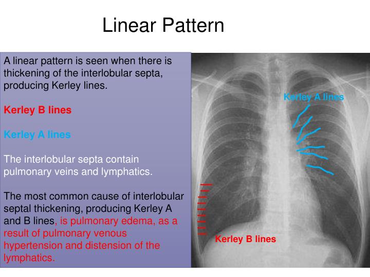 PPT - Interstial lung disease PowerPoint Presentation - ID:3986959
