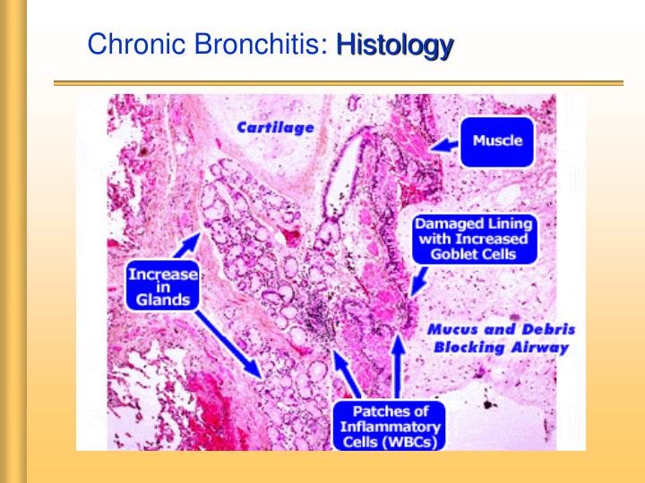 PPT - Obstructive Pulmonary Diseases PowerPoint Presentation - ID:3996909