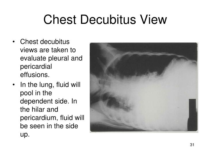 X-Ray Chest Decubitus at Jacob Freeman blog