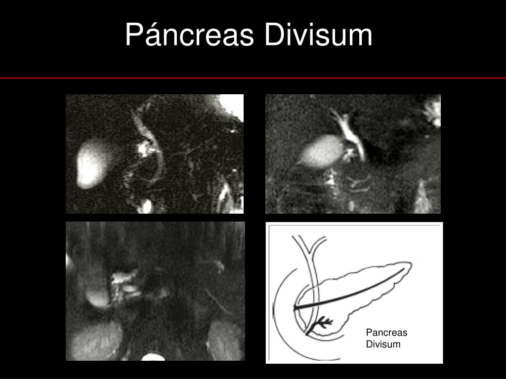 PPT - Estudio de las Anomalías Pancreatobiliares y de su Repercusión ...
