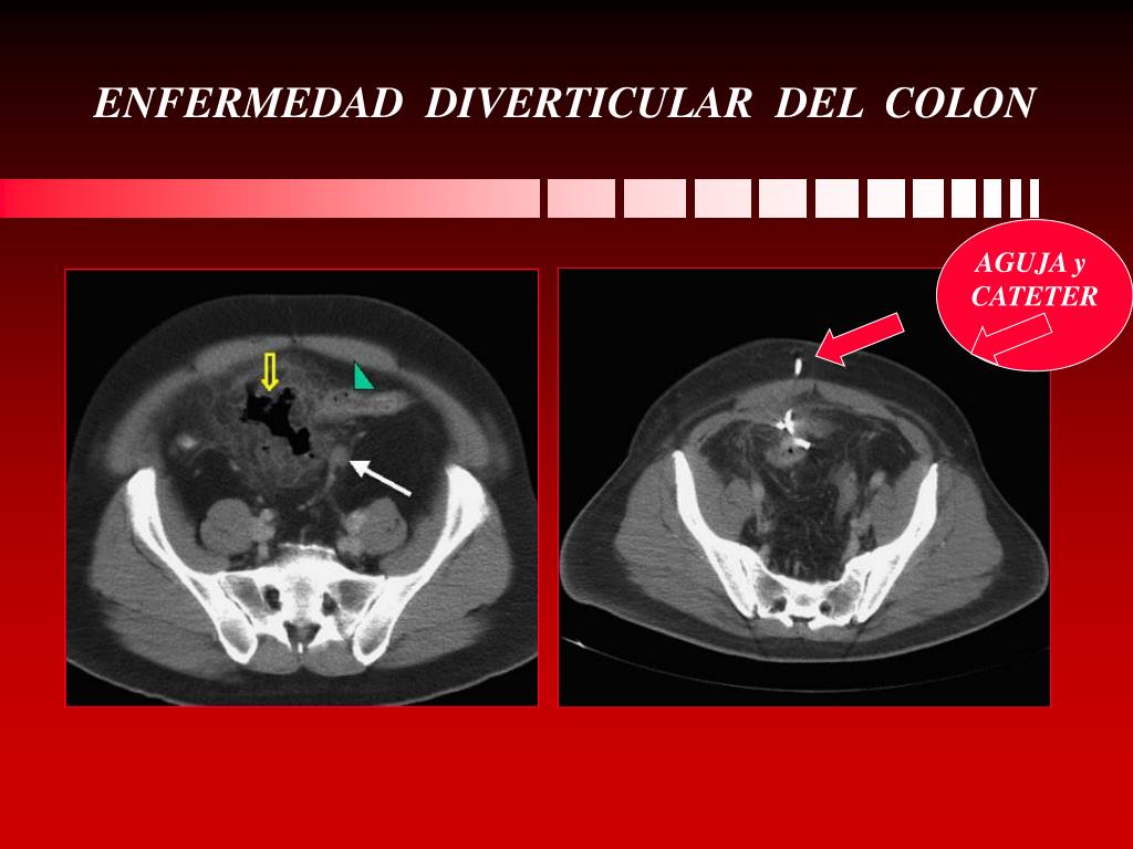 Ppt Enfermedad Diverticular Del Colon Powerpoint Presentation Free