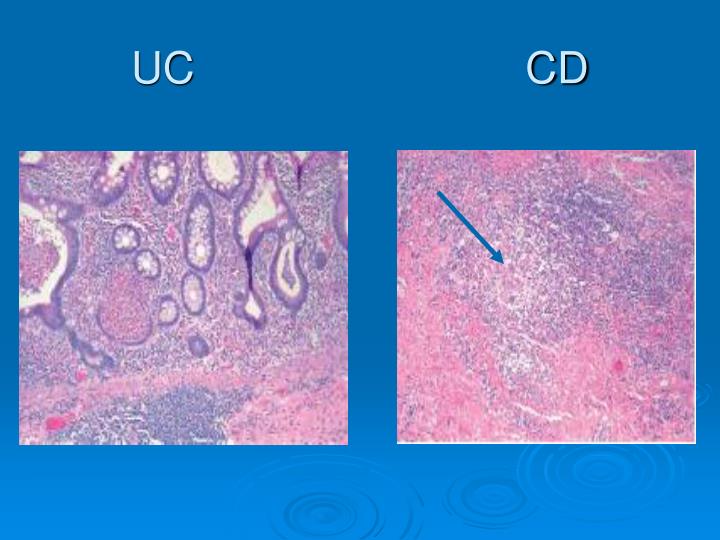 PPT - Inflammatory bowel disease PowerPoint Presentation - ID:4002630
