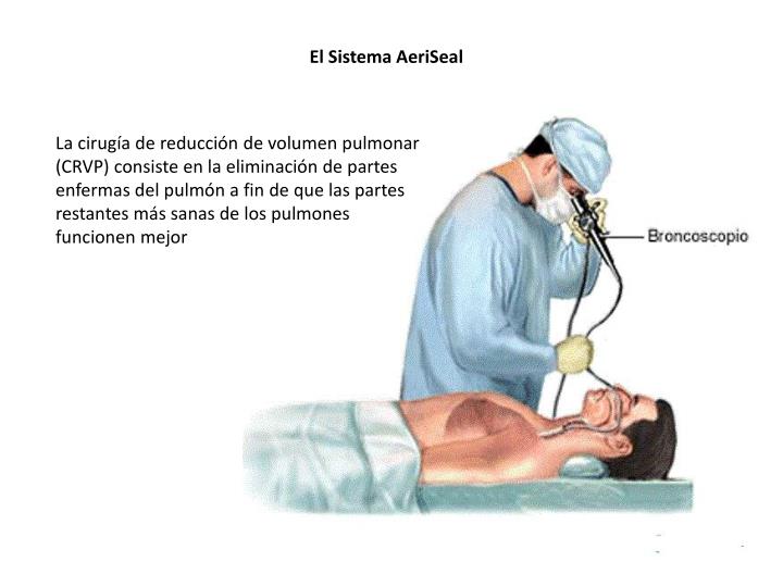 PPT - Enfisema Pulmonar Professor: Verónica Pantoja . Lic. MSP ...