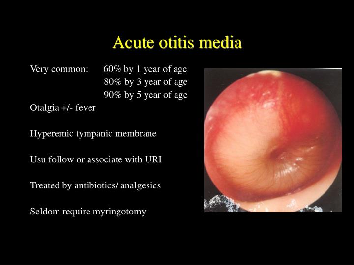 PPT - Diseases of Middle Ear PowerPoint Presentation - ID:4007153
