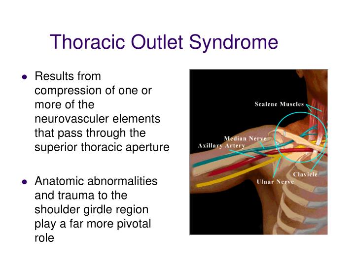 Neurological thoracic outlet syndrome - seryhack