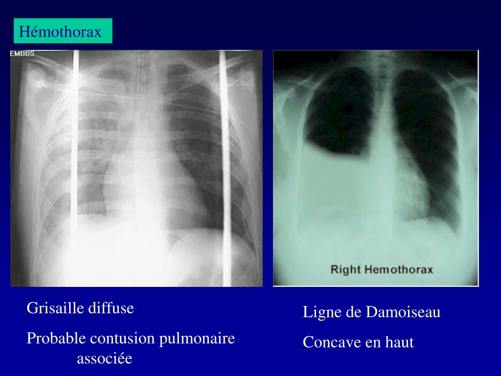 PPT - TRAUMATISMES DE LA PAROI THORACIQUE ET DES VOIES RESPIRATOIRES ...