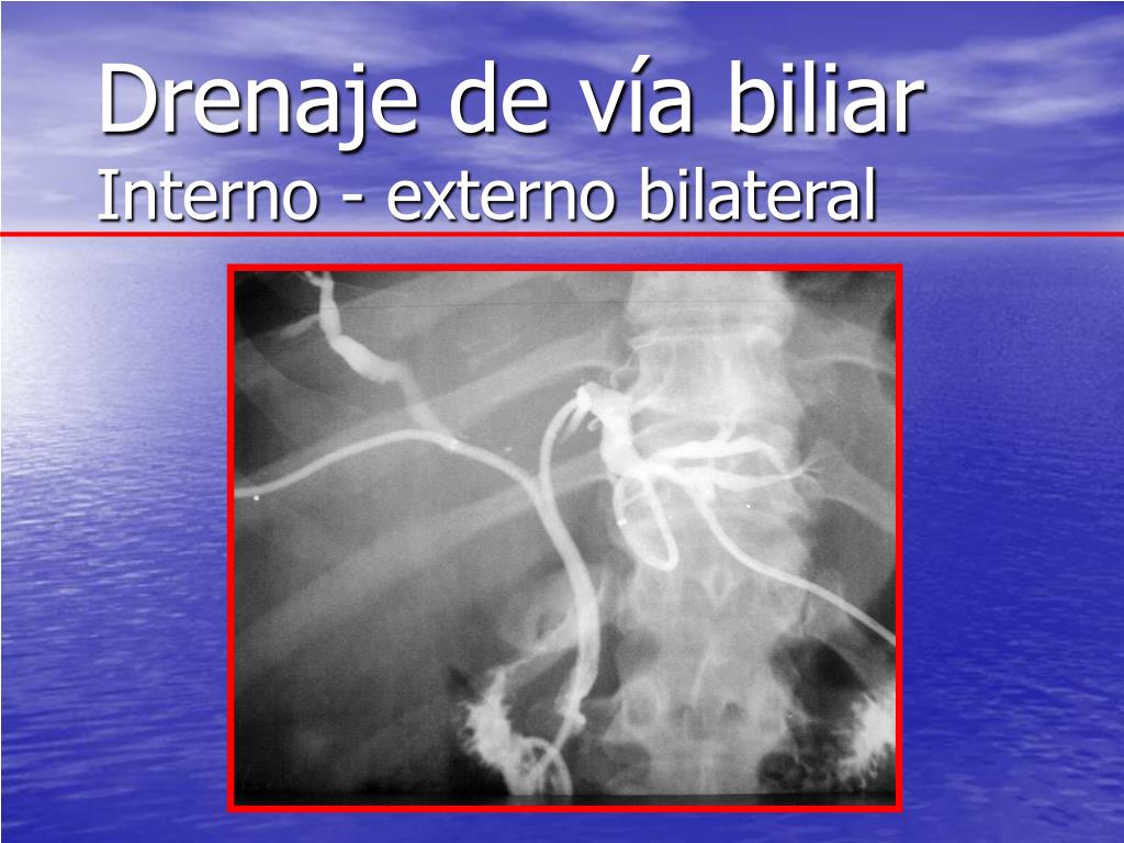 PPT - Evacuaci ó n lenta con jeringa del contenido Conectar a un ...