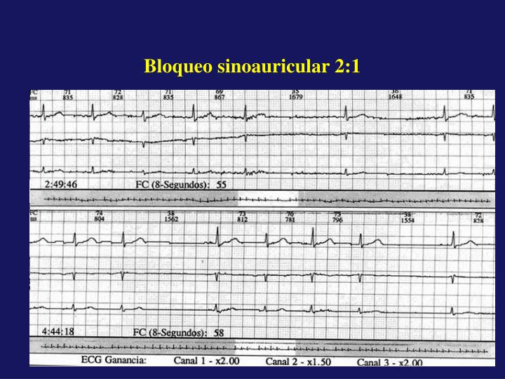 PPT - Enfermedad del Nodulo Sinusal Bradiarritmias PowerPoint ...