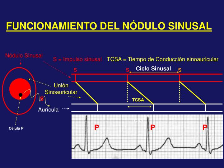 PPT - Enfermedad del Nodulo Sinusal Bradiarritmias PowerPoint ...