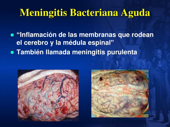 PPT - Meningitis Bacteriana Aguda PowerPoint Presentation - ID:4016659