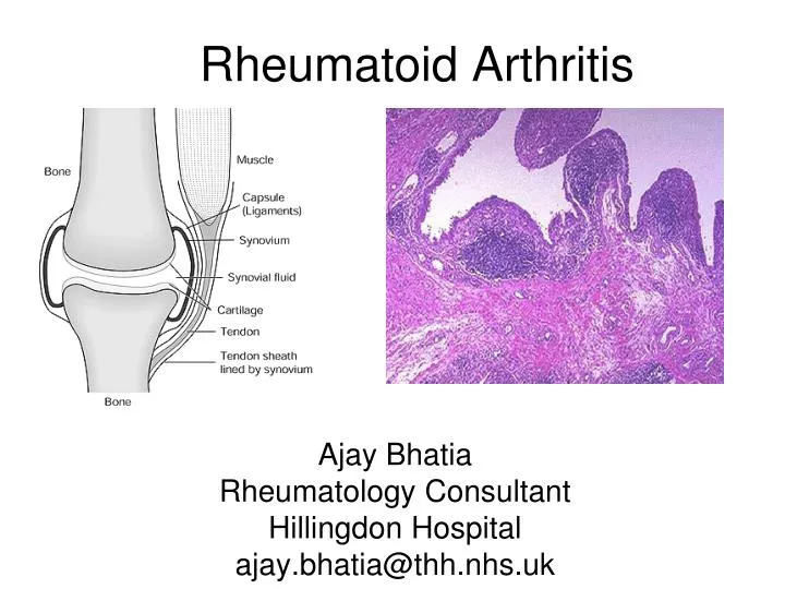PPT - Rheumatoid Arthritis PowerPoint Presentation, free download - ID ...