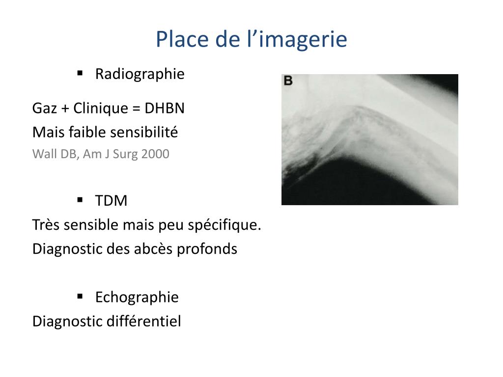 PPT - Dermo-hypodermites bactériennes nécrosantes PowerPoint ...