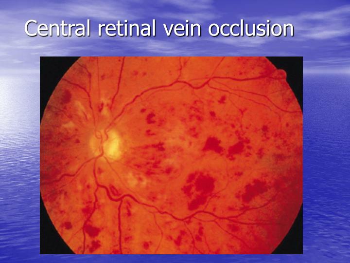 PPT - Lecture 3 EYE CHANGES IN SYSTEMIC DISEASES EMMERGENCY IN ...