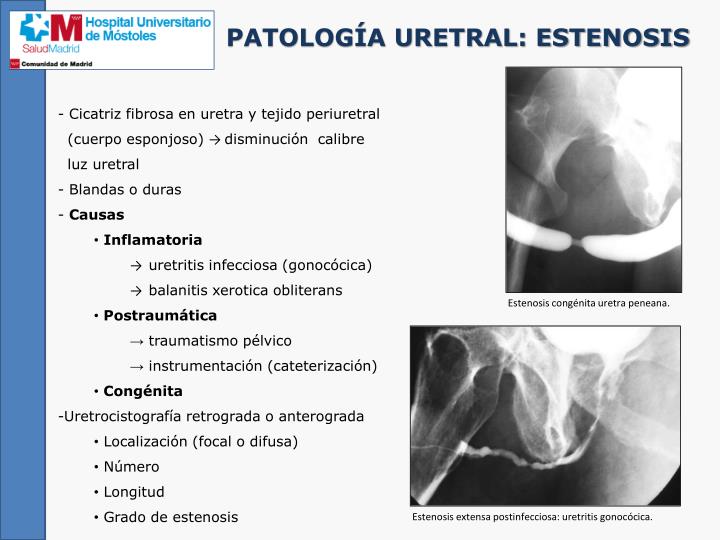 PPT - Uretrografía retrograda: revisión de la patología uretral ...