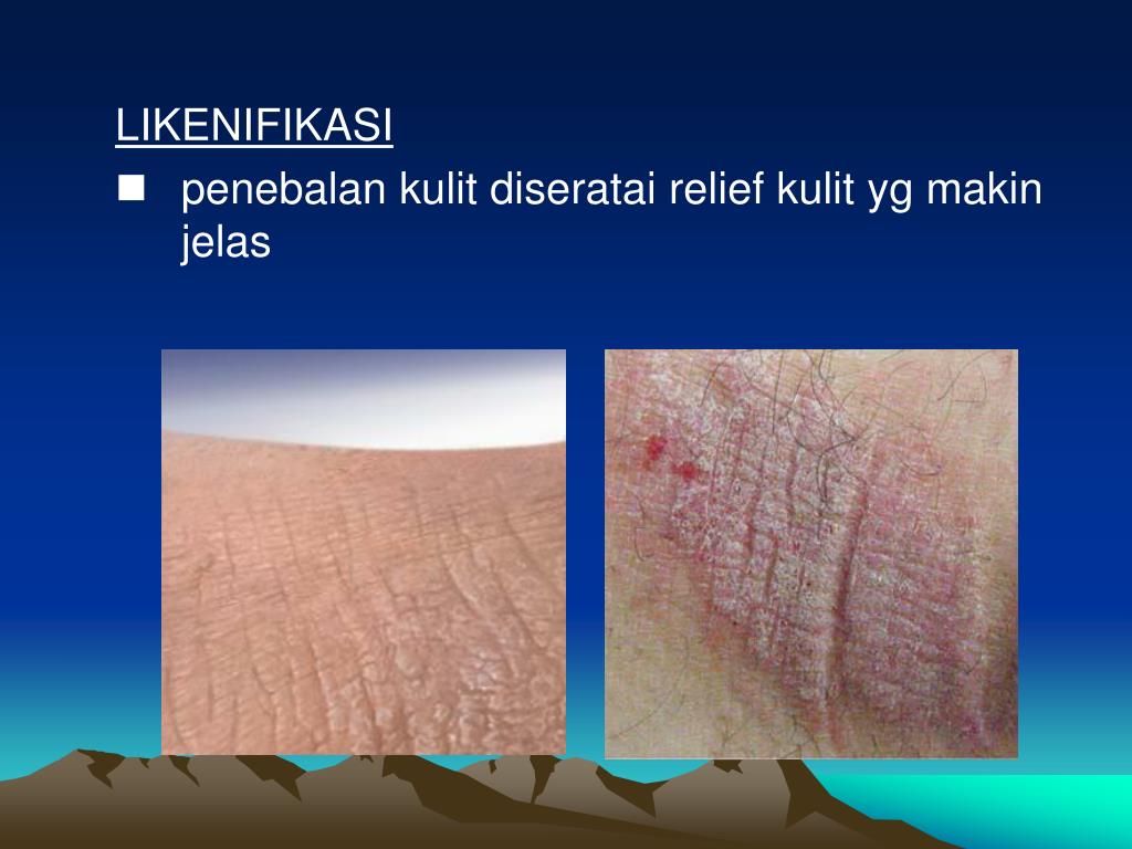 PPT - MAKULA : perubahan warna kulit semata tanpa perubahan konsistensi ...