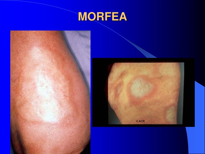 PPT - KOLLAJEN DOKU HASTALIKLARI PowerPoint Presentation - ID:4037388