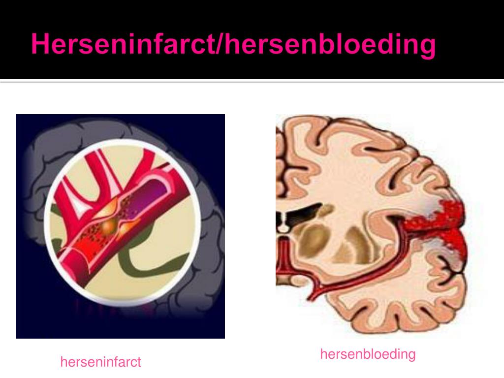 PPT - Zorgvrager met Cerebro Vasculair Accident (CVA) PowerPoint ...