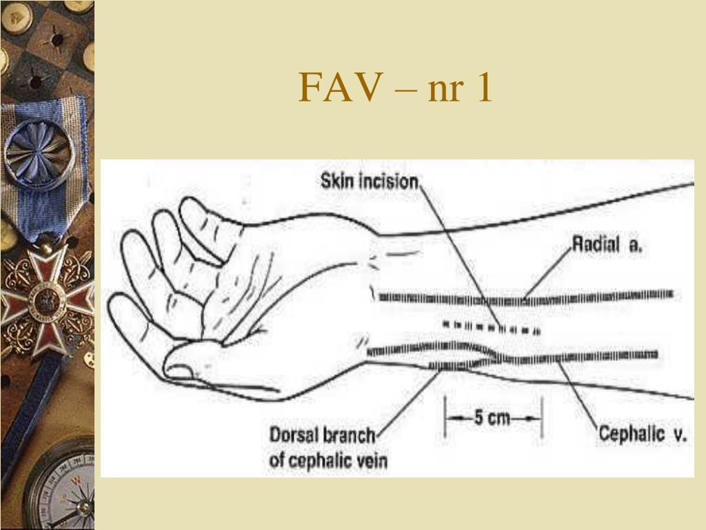 PPT - DIALIZA PERITONEALĂ SI HEMODIALIZA PowerPoint Presentation, free ...