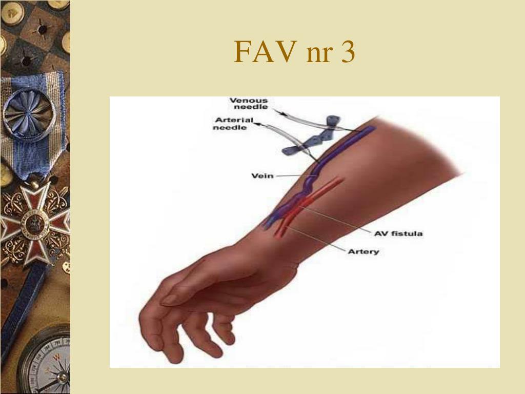 PPT - DIALIZA PERITONEALĂ SI HEMODIALIZA PowerPoint Presentation, free ...