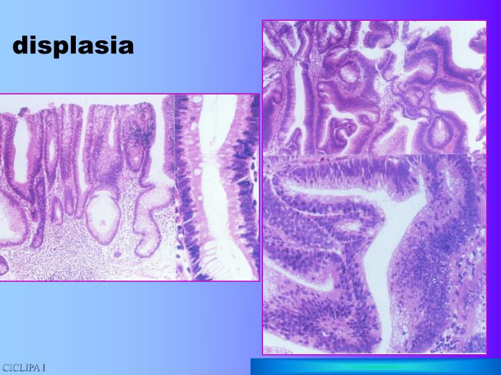 PPT - Tumores rectocolónicos PowerPoint Presentation - ID:4046848