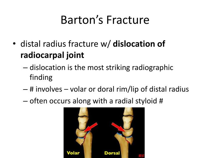 PPT - Distal Radius Fractures PowerPoint Presentation - ID:4048273
