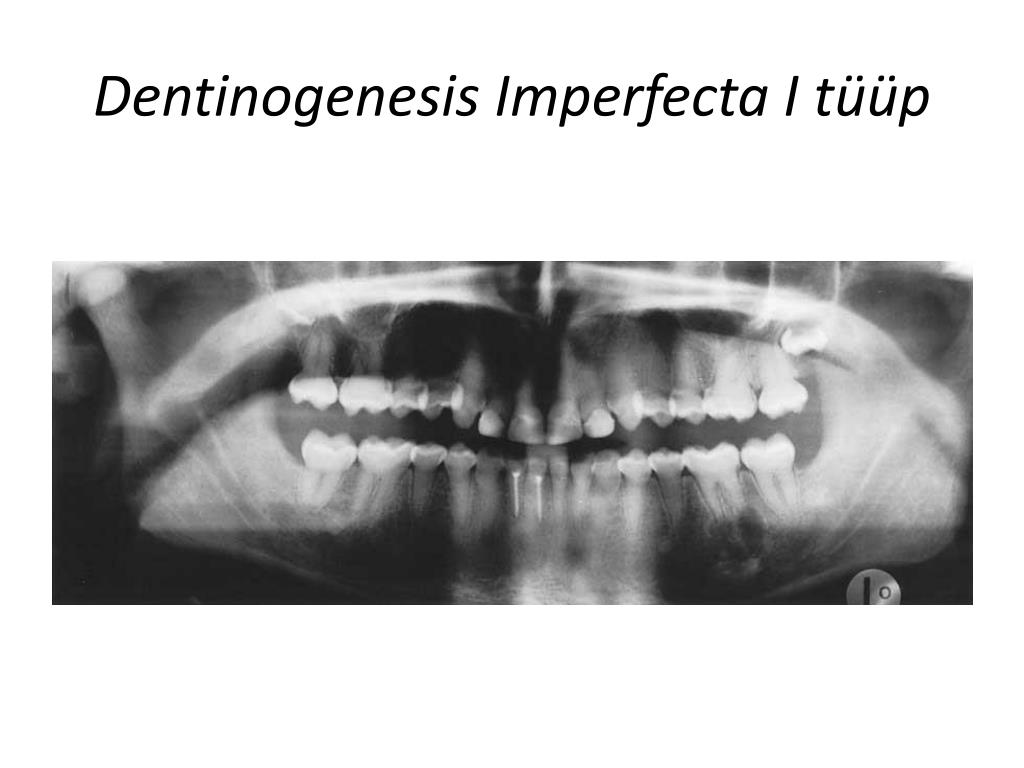 PPT - Hammaste morfoloogilised muutused Dentinogenesis Imperfecta puhul ...