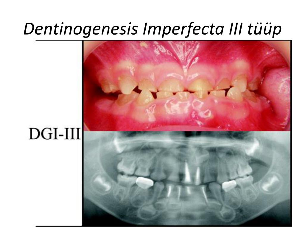 PPT - Hammaste morfoloogilised muutused Dentinogenesis Imperfecta puhul ...