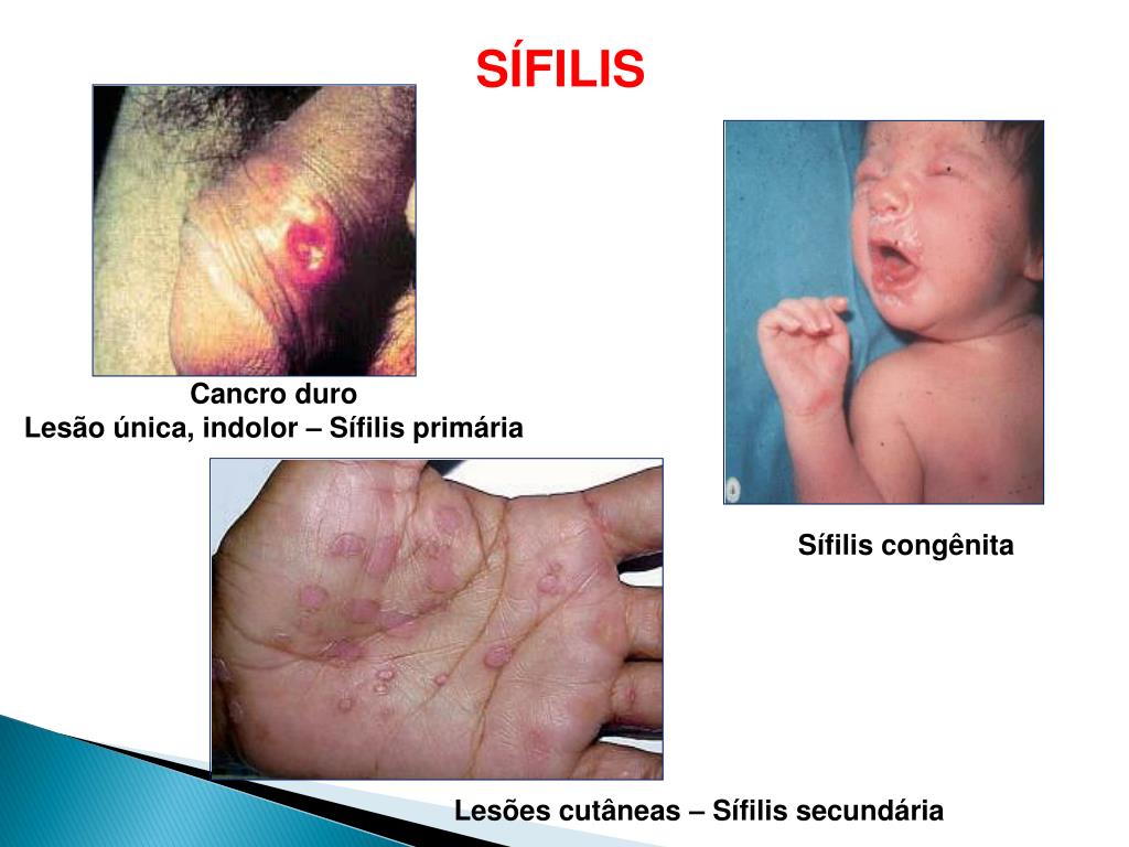 Ppt Microbiologia ClÍnica DoenÇas Sexualmente TransmissivÉis Dst