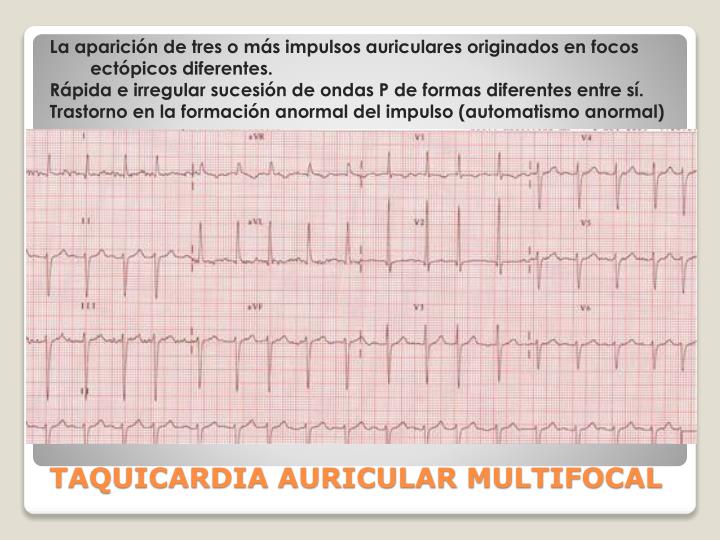 PPT - TAQUICARDIAS SUPRAVENTRICULARES PowerPoint Presentation - ID:4055258
