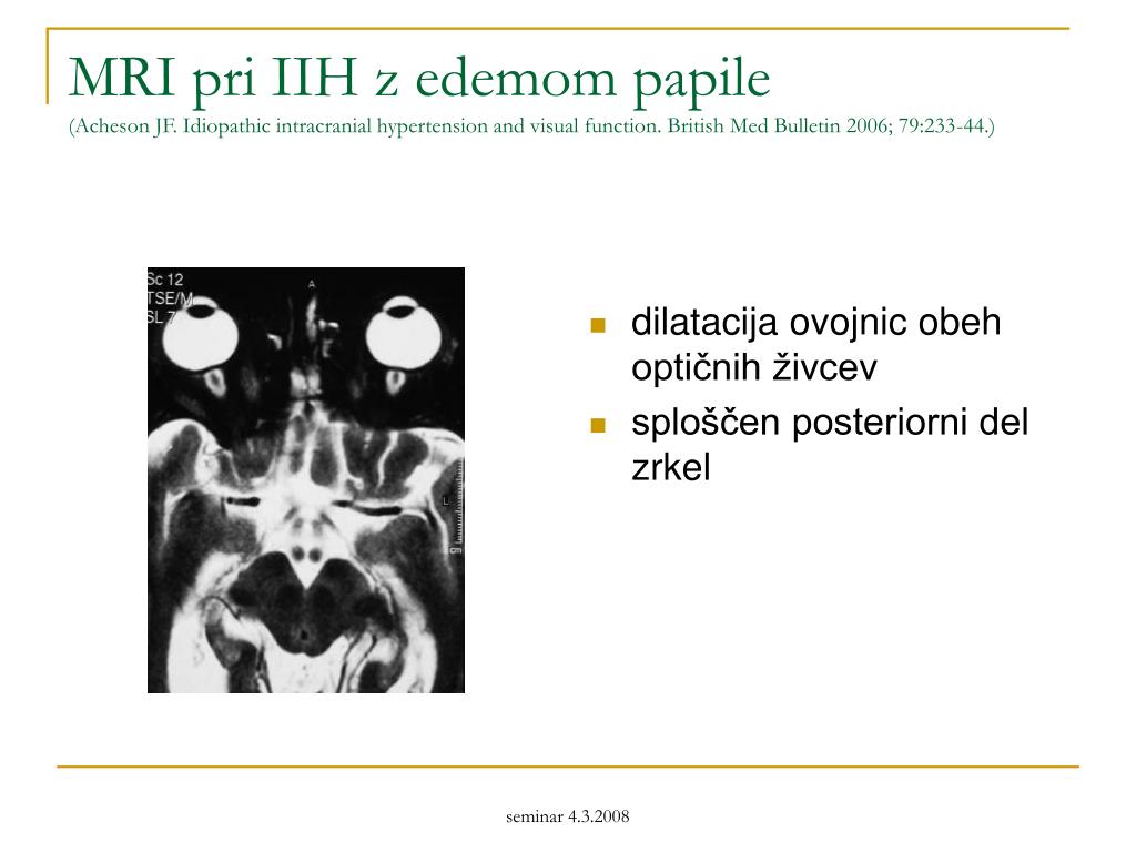 PPT - Zastojna papila in intrakranialna hipertenzija PowerPoint ...