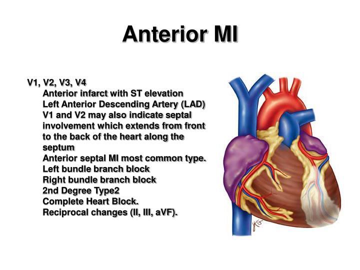 PPT - Myocardial Infarction PowerPoint Presentation - ID:4058794