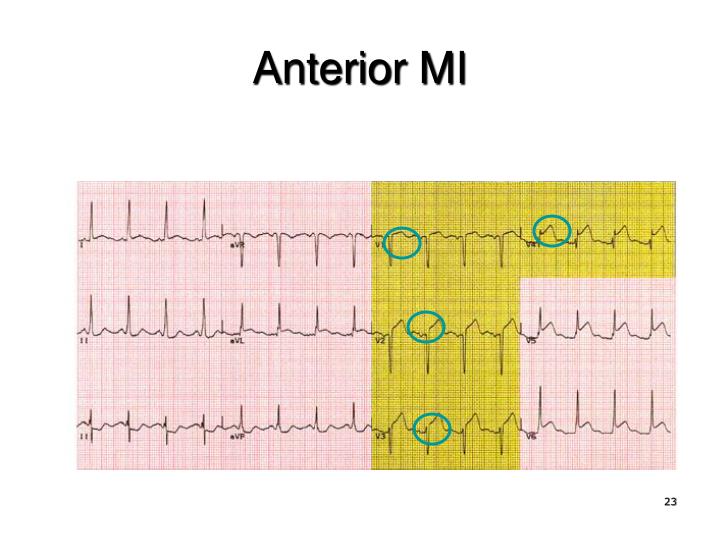 PPT - Myocardial Infarction PowerPoint Presentation - ID:4058794