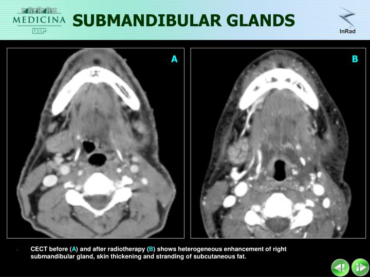 PPT - Image evaluation of head and neck after radiation therapy ...