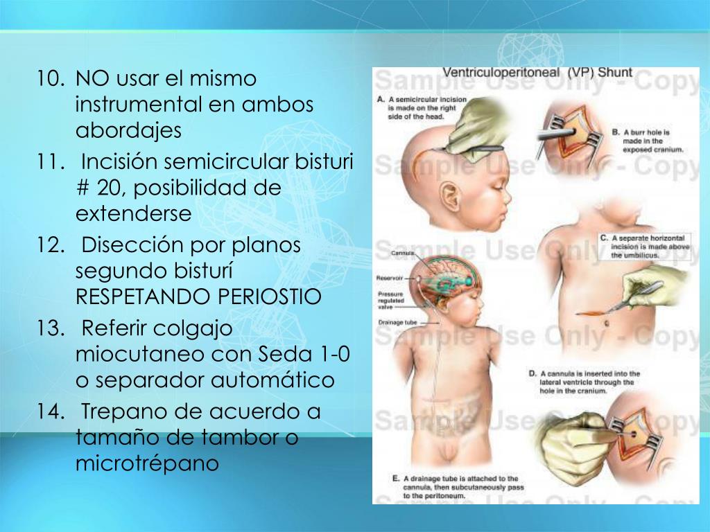 PPT - Derivación ventriculoperitoneal y derivación ventriculoatrial ...
