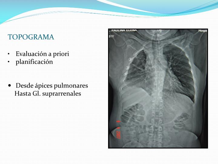 PPT - TOMOGRAFIA DE TORAX PowerPoint Presentation - ID:4067664