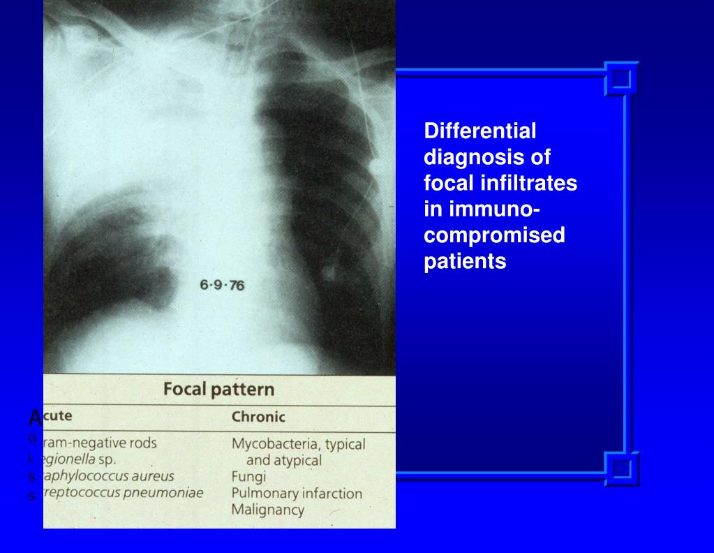 PPT - Respiratory Tract Infections In the Emergency Department ...