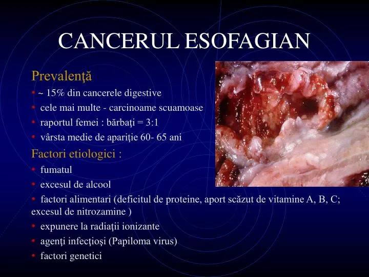 PPT - CANCERUL ESOFAGIAN PowerPoint Presentation, free download - ID ...