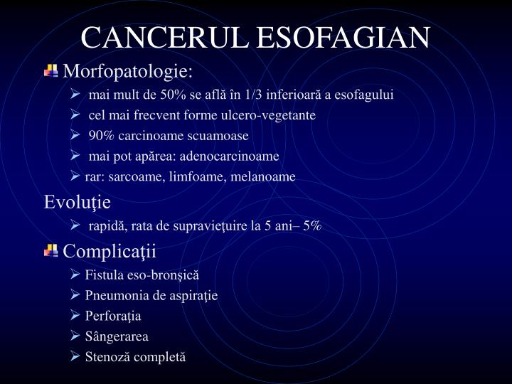PPT - CANCERUL ESOFAGIAN PowerPoint Presentation - ID:4079500