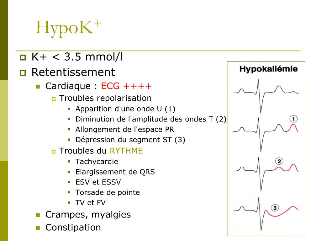 PPT - Dyskaliémies PowerPoint Presentation, free download - ID:4080791