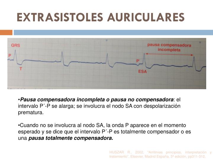 PPT - Extrasístoles y Síndromes de preexitación: WPW y Long-Ganong-L ...