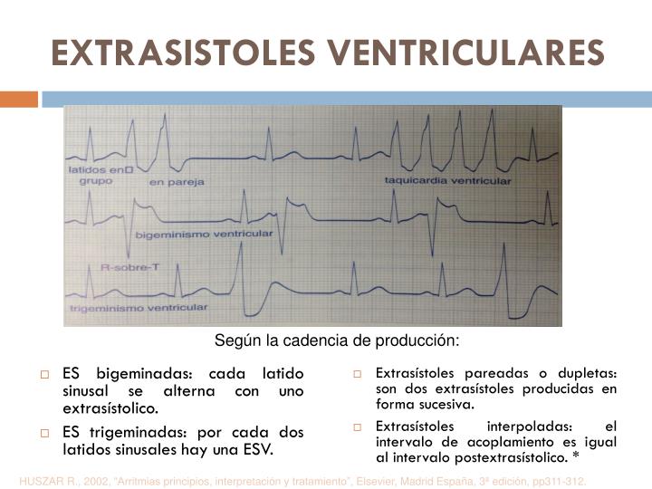 PPT - Extrasístoles y Síndromes de preexitación: WPW y Long-Ganong-L ...