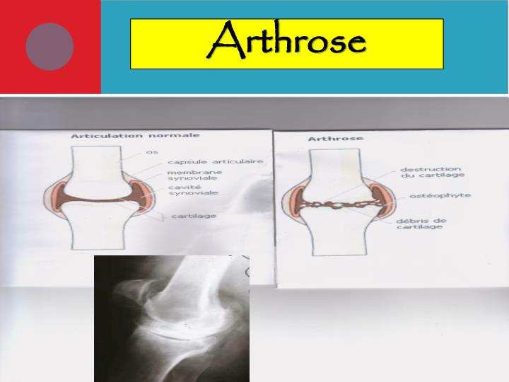 PPT - Les douleurs ostéo -articulaires. Approche diagnostique et cas ...