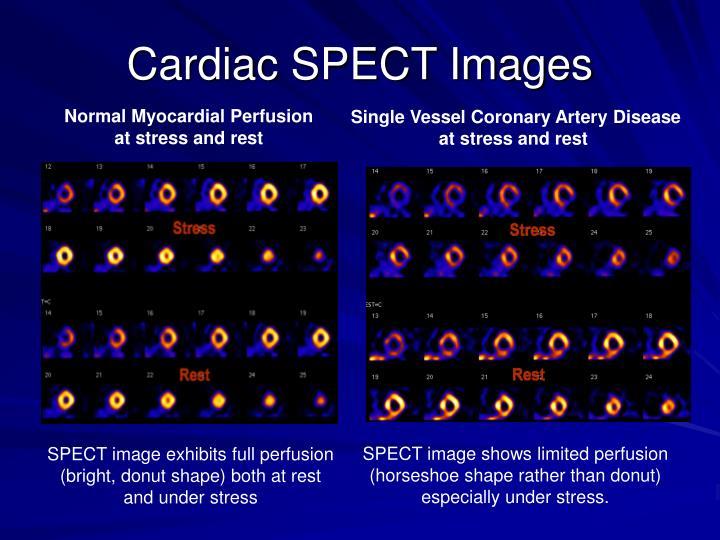 PPT - Single Photon Emission Computed Tomography (SPECT) PowerPoint ...