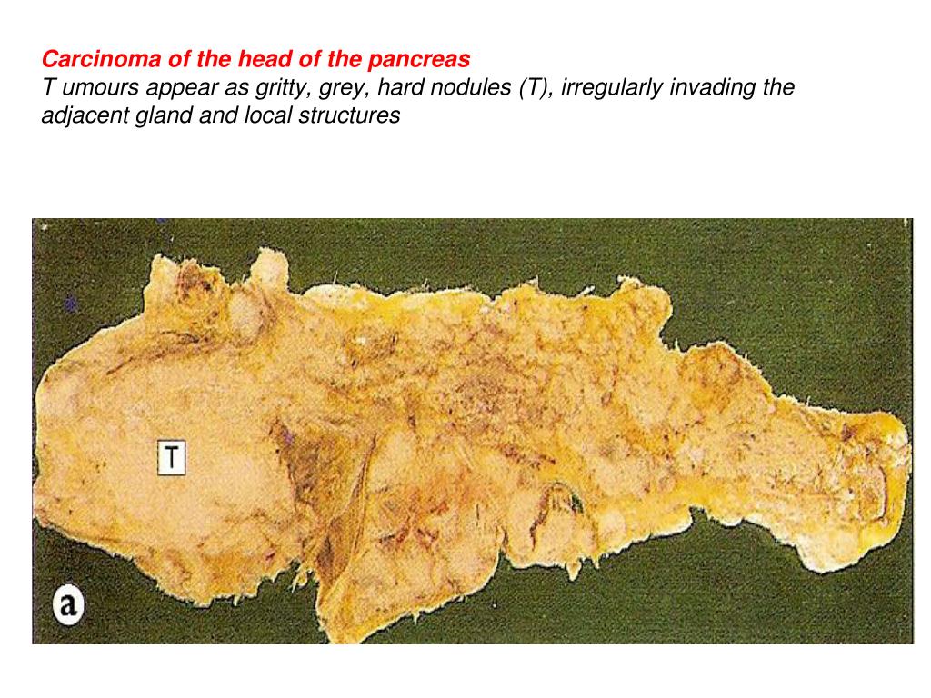 PPT - Describe etio-pathogenesis and morphology of: Acute and chronic ...
