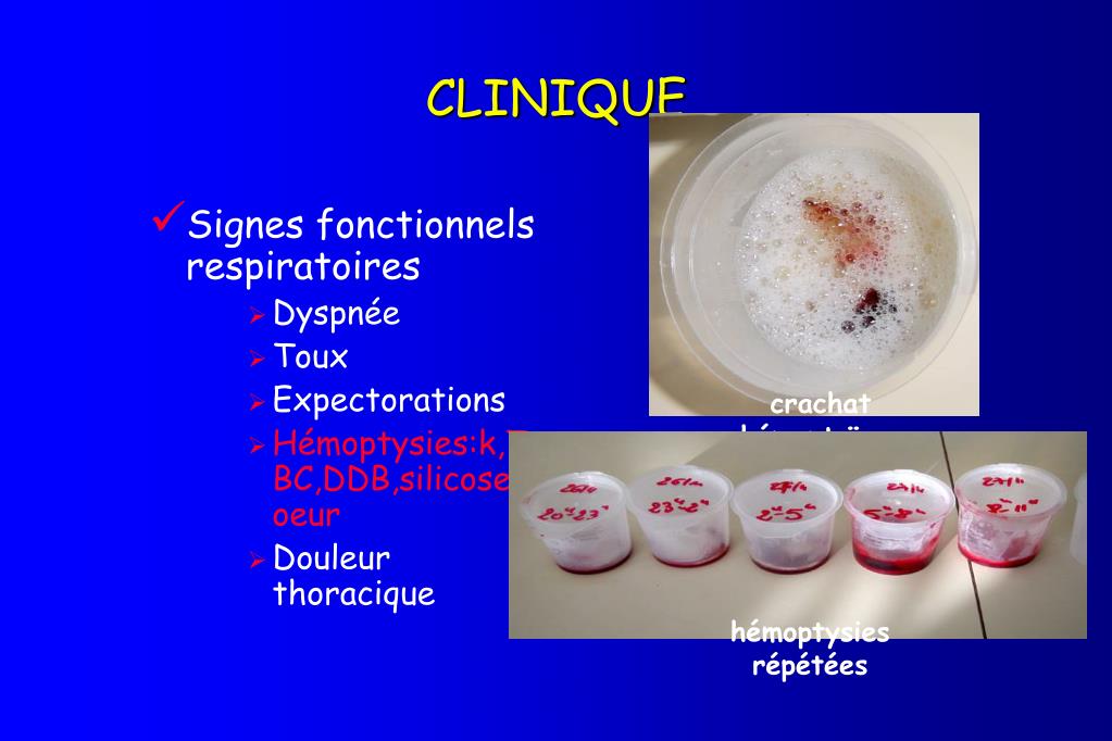 PPT - DEMARCHE DIAGNOSTIQUE EN PNEUMOLOGIE L.LUCACI CENTRE HOSPITALIER ...