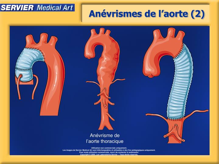 PPT - Artères - physiopathologie PowerPoint Presentation - ID:4095798