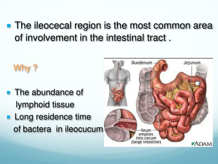 PPT - Intestinal Tuberculosis PowerPoint Presentation - ID:4098224