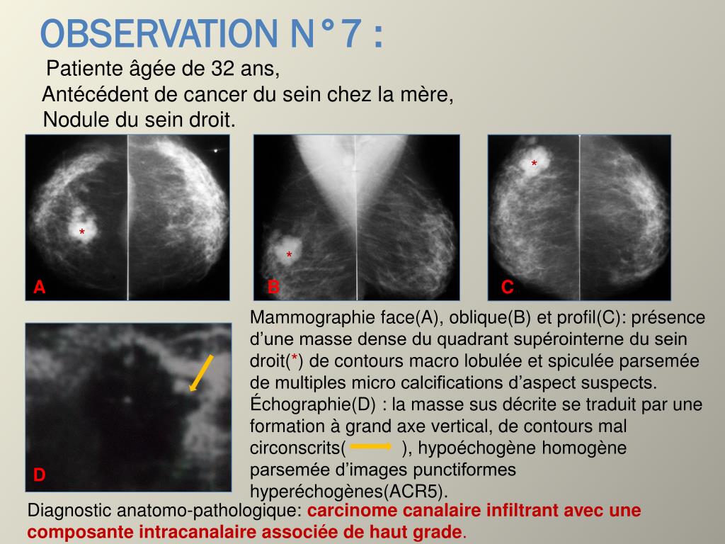 Ppt Le Cancer Du Sein De La Femme Jeune A Propos De 28 Cas Breast