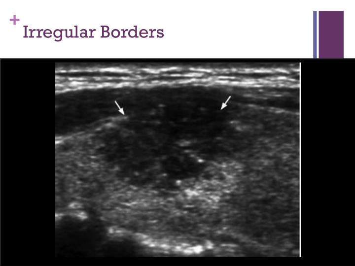 PPT - Thyroid Nodules and Cancer PowerPoint Presentation - ID:4110559
